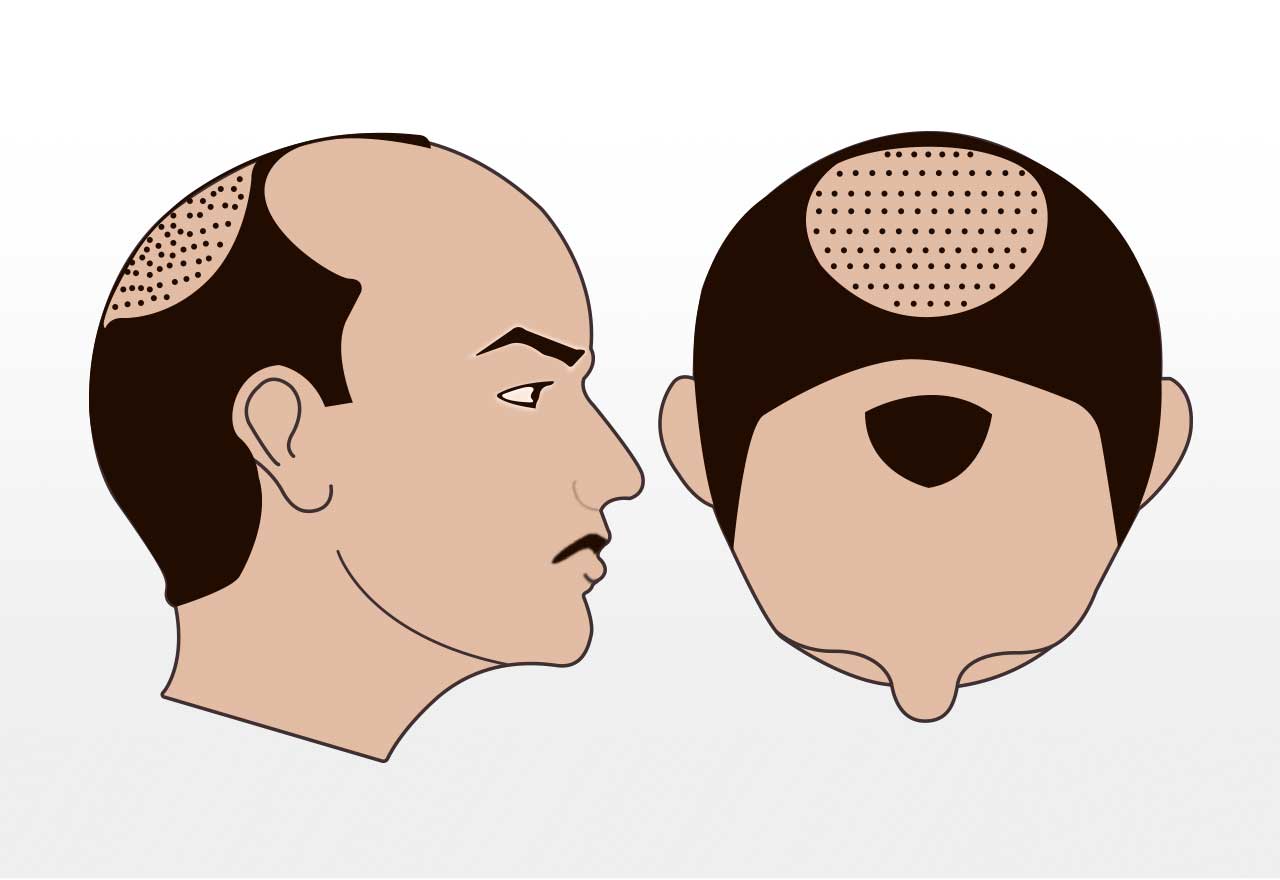 What is a graft? | Beauty Travels 24